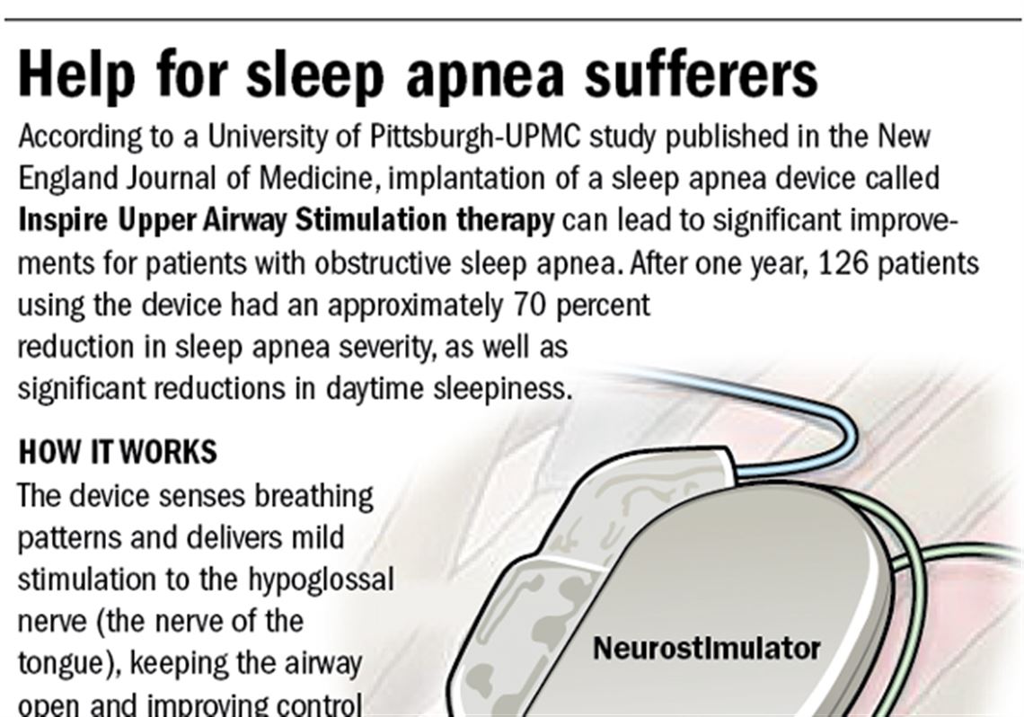 New sleep apnea device a sigh of relief | Pittsburgh Post-Gazette